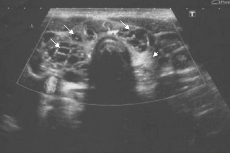 Terapéutica en bocio multinodular