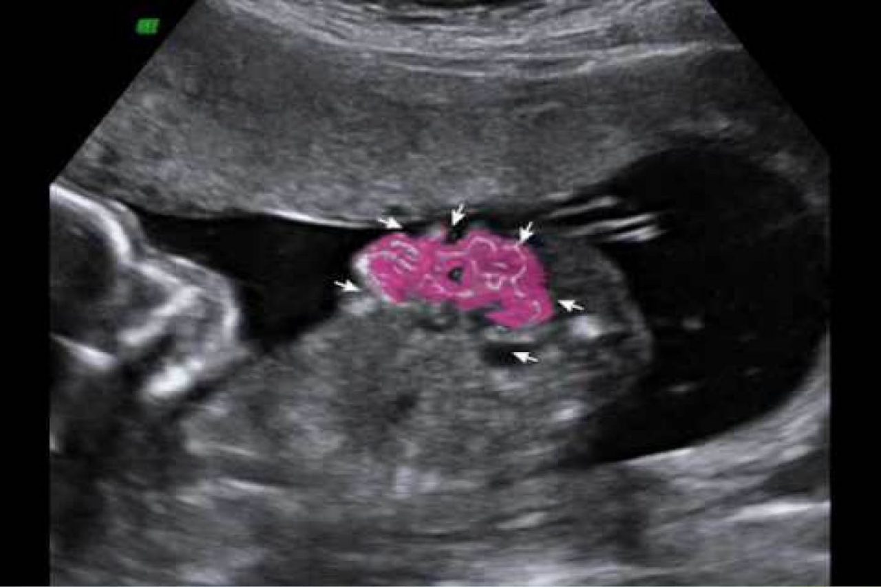 Defectos de la pared abdominal. Estudio comparativo entre onfalocele y ...