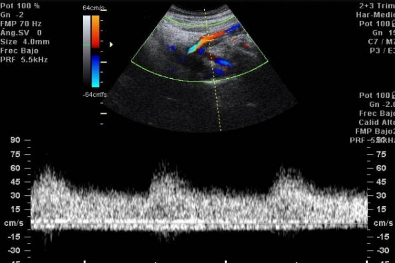 Velocimetría doppler de las arterias uterinas en el embarazo