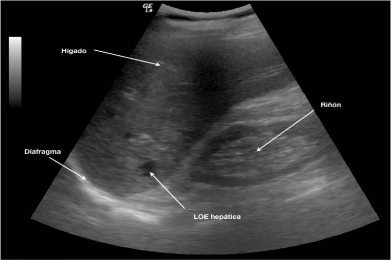 Esteatosis hepática y sus manifestaciones en los distintos métodos de ...