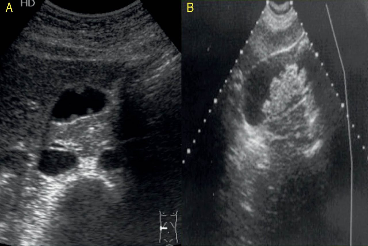 Cáncer de vesícula biliar