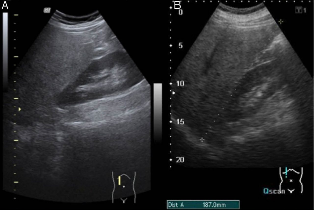 Esteatosis hepática - Ultrasonografía Médica