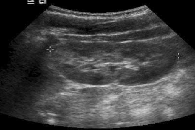 Ecografía Bidimensional y Doppler en el diagnóstico y seguimiento de ...